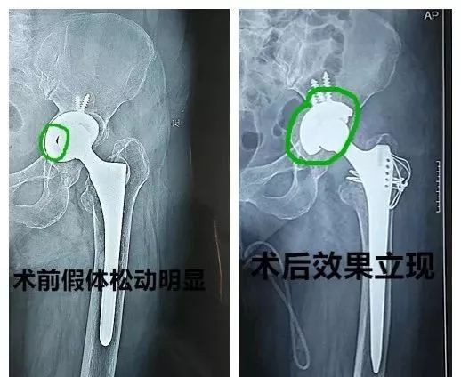 青岛3D打印技术指导进行髋关节翻修术 - 青岛斯玛特电子科技有限公司